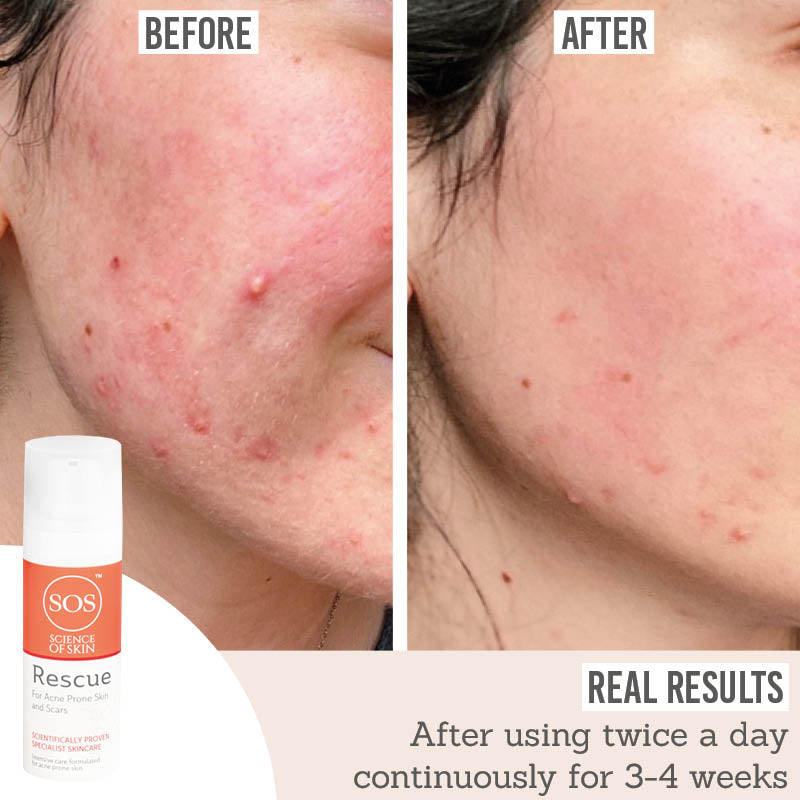 Science of Skin Rescue | Spot & Scar Cream – Beauty and the Boutique